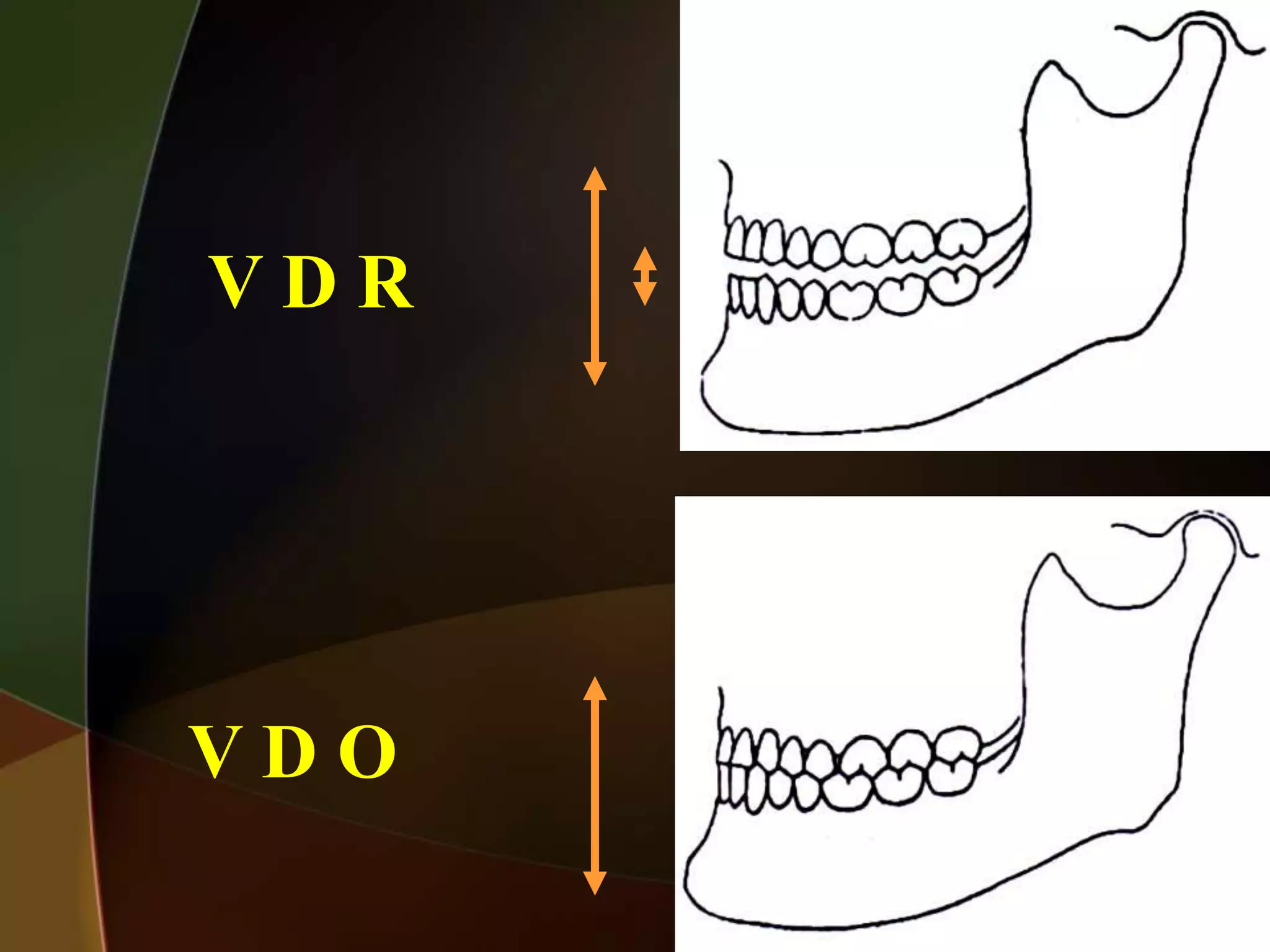 Complete Denture 4- Maxillo-mandibular Relation Records d- Vertical ...