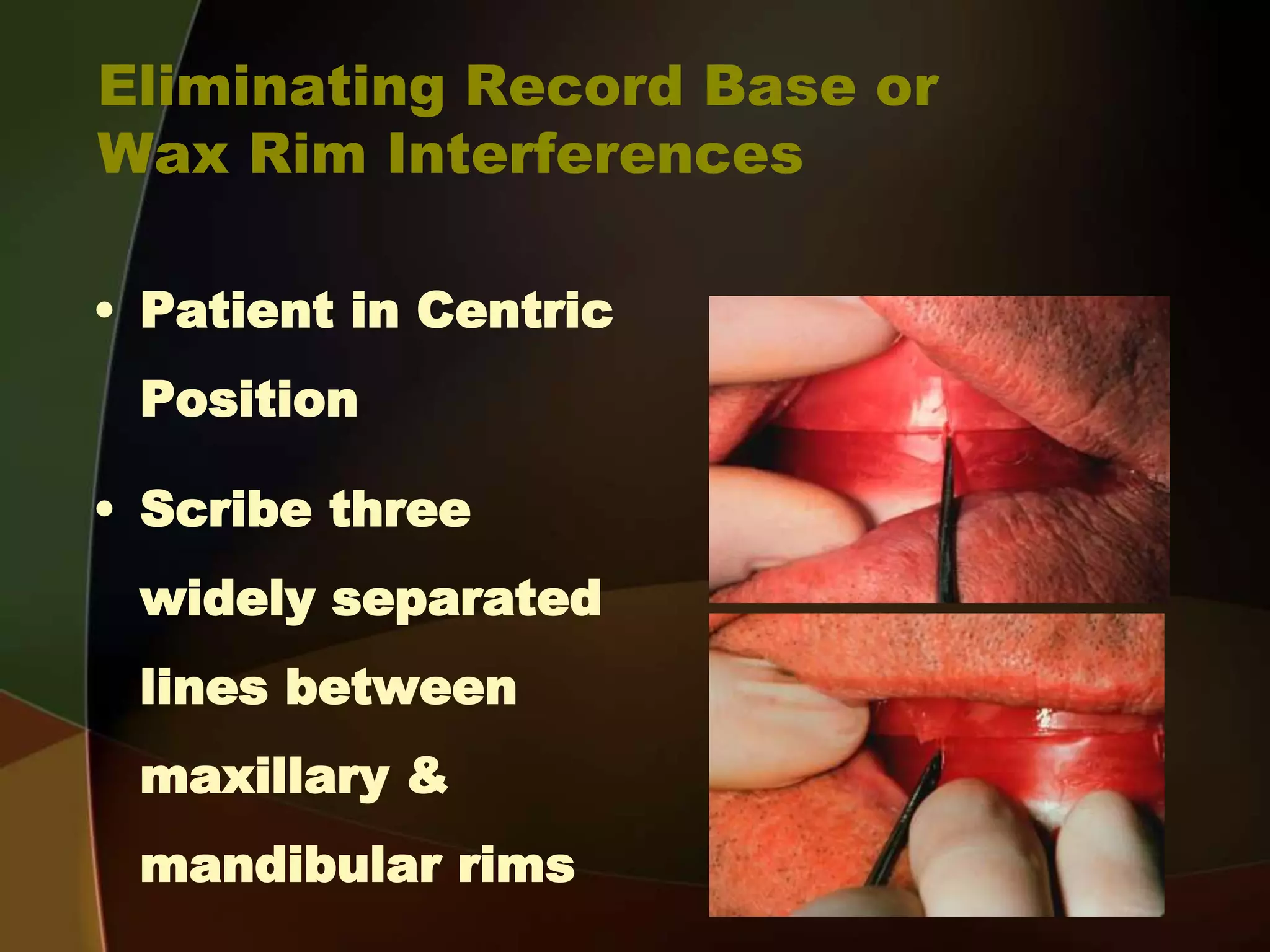 Complete Denture 4- Maxillo-mandibular Relation Records d- Vertical ...