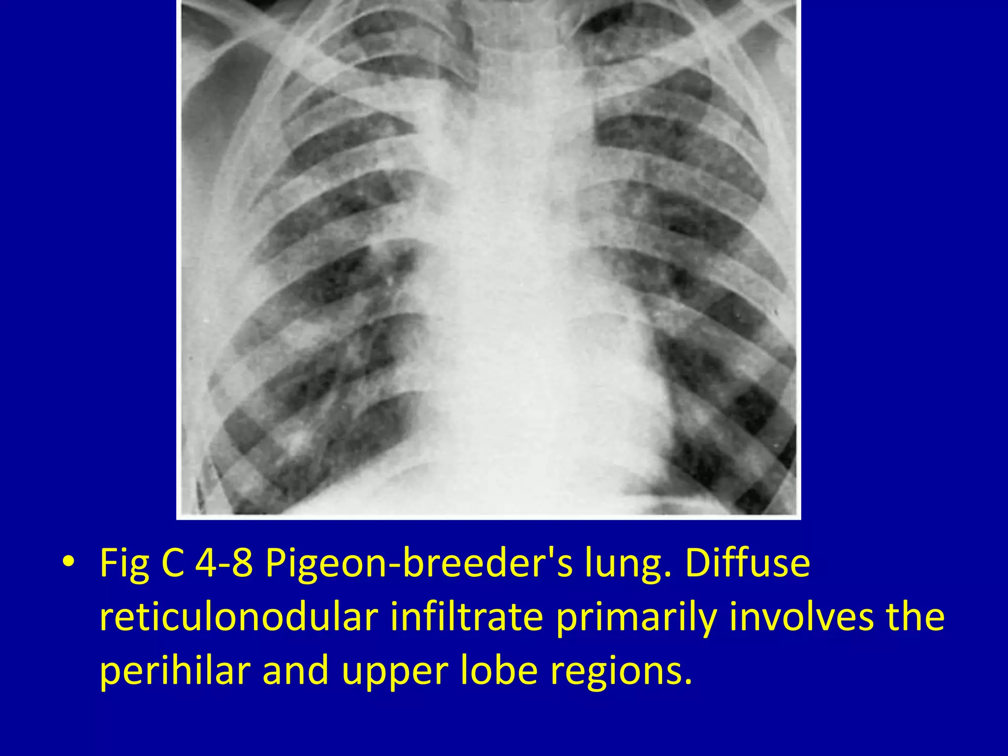 4 diffuse reticular or reticulonodular pattern | PPTX