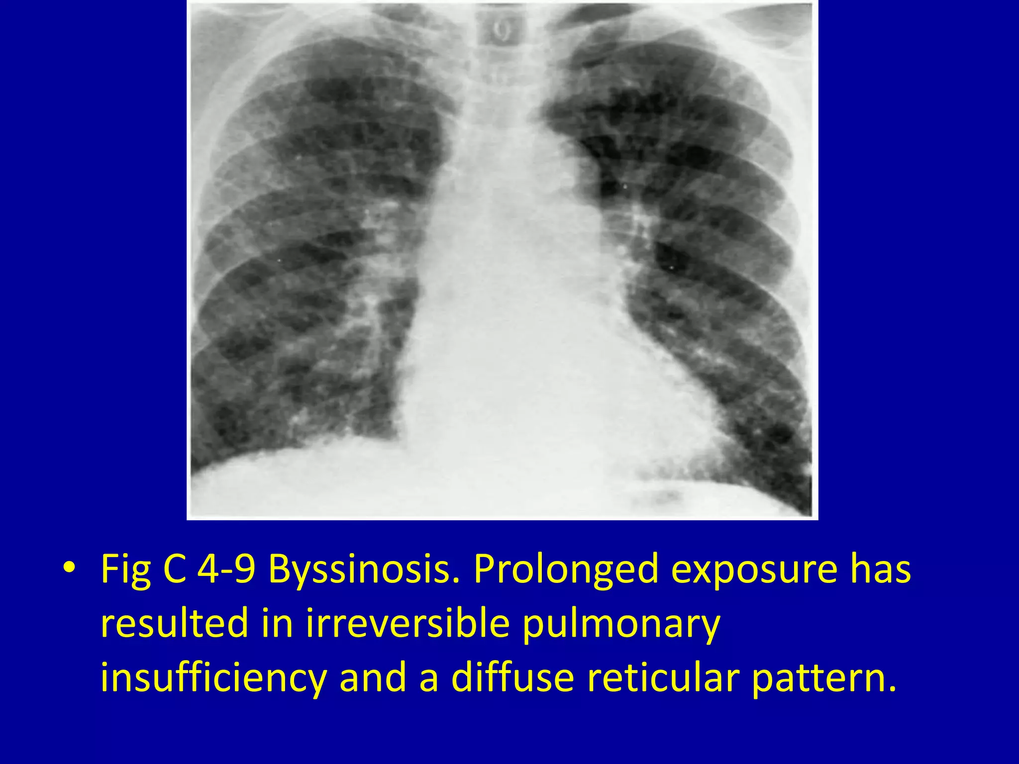 4 diffuse reticular or reticulonodular pattern | PPTX