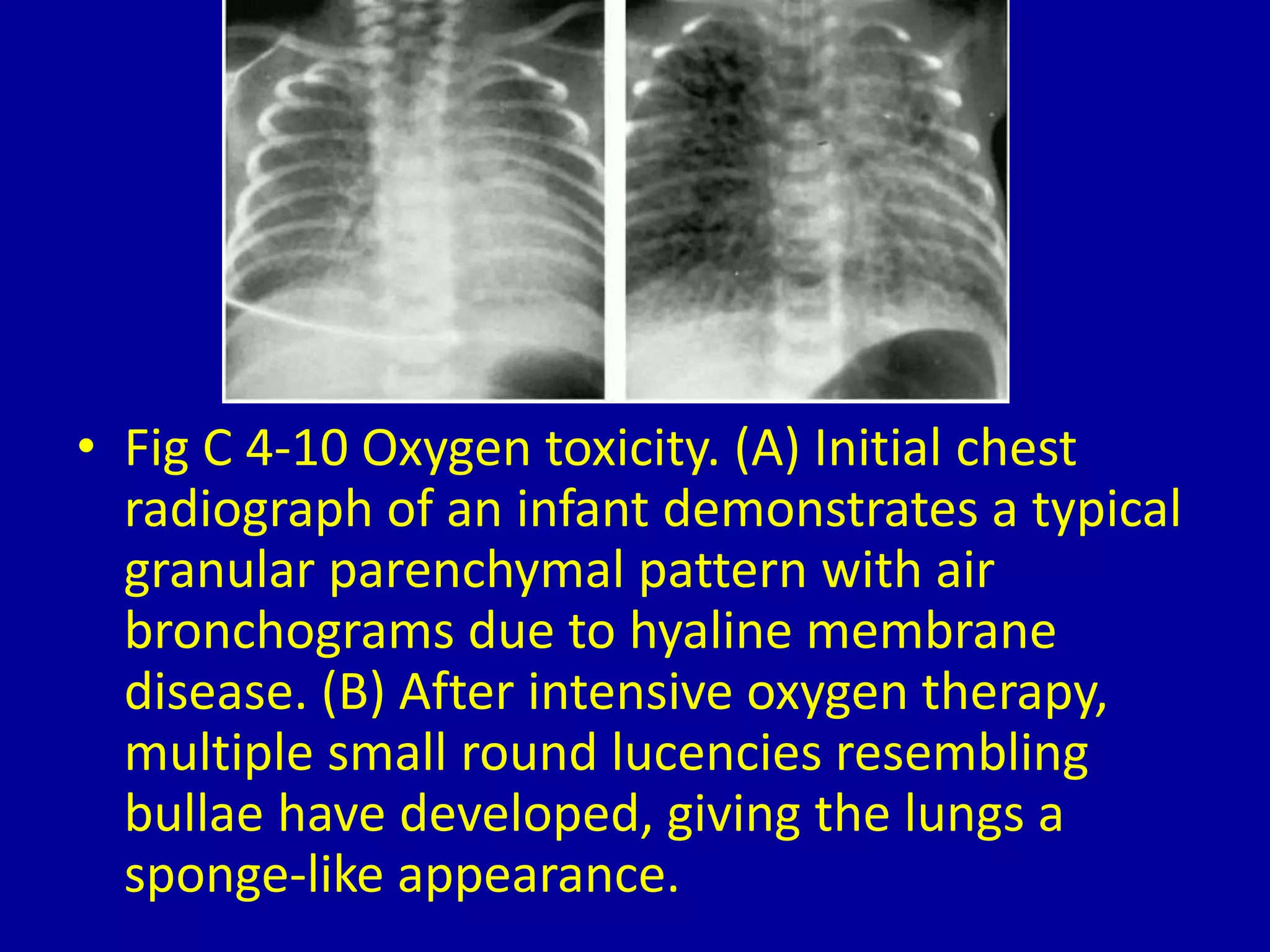 4 diffuse reticular or reticulonodular pattern | PPTX