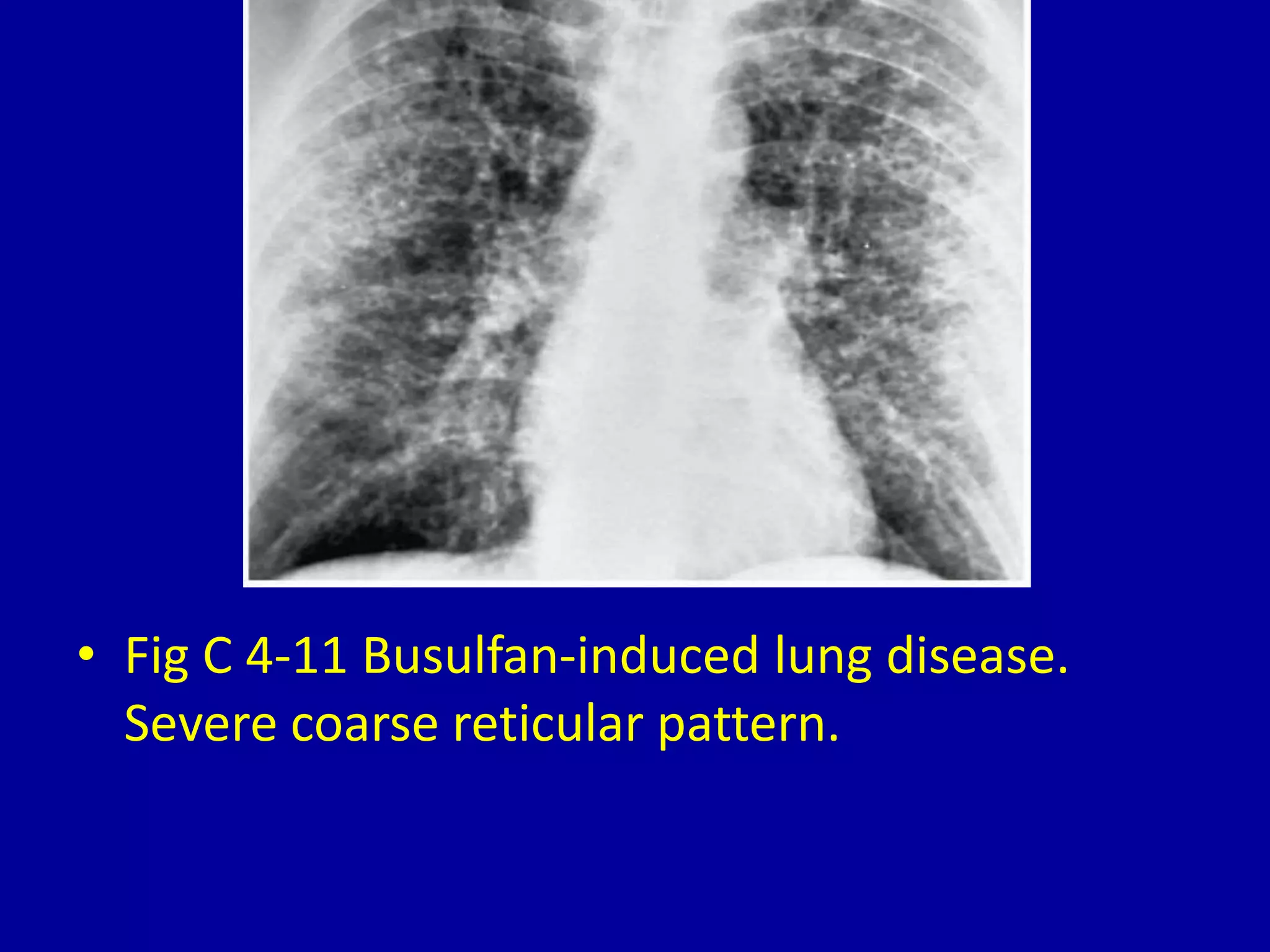 4 diffuse reticular or reticulonodular pattern | PPTX