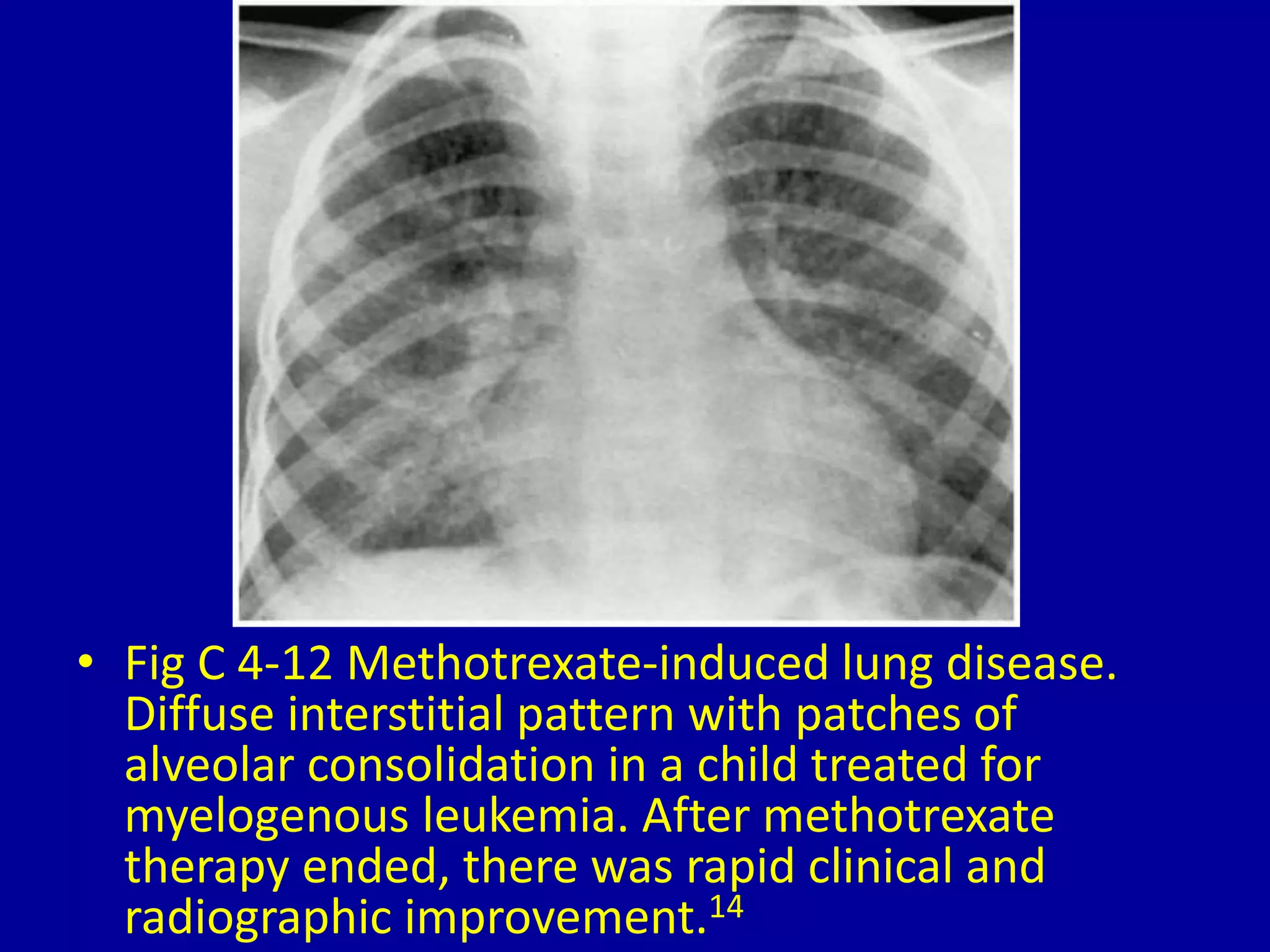 4 diffuse reticular or reticulonodular pattern | PPTX