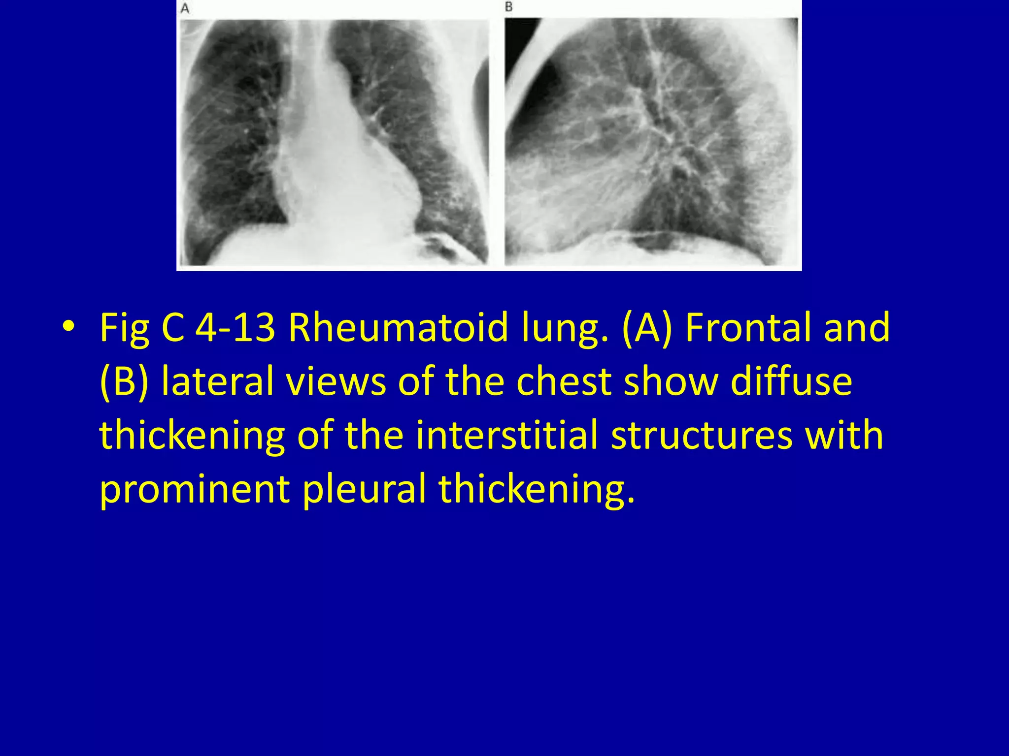 4 diffuse reticular or reticulonodular pattern | PPTX