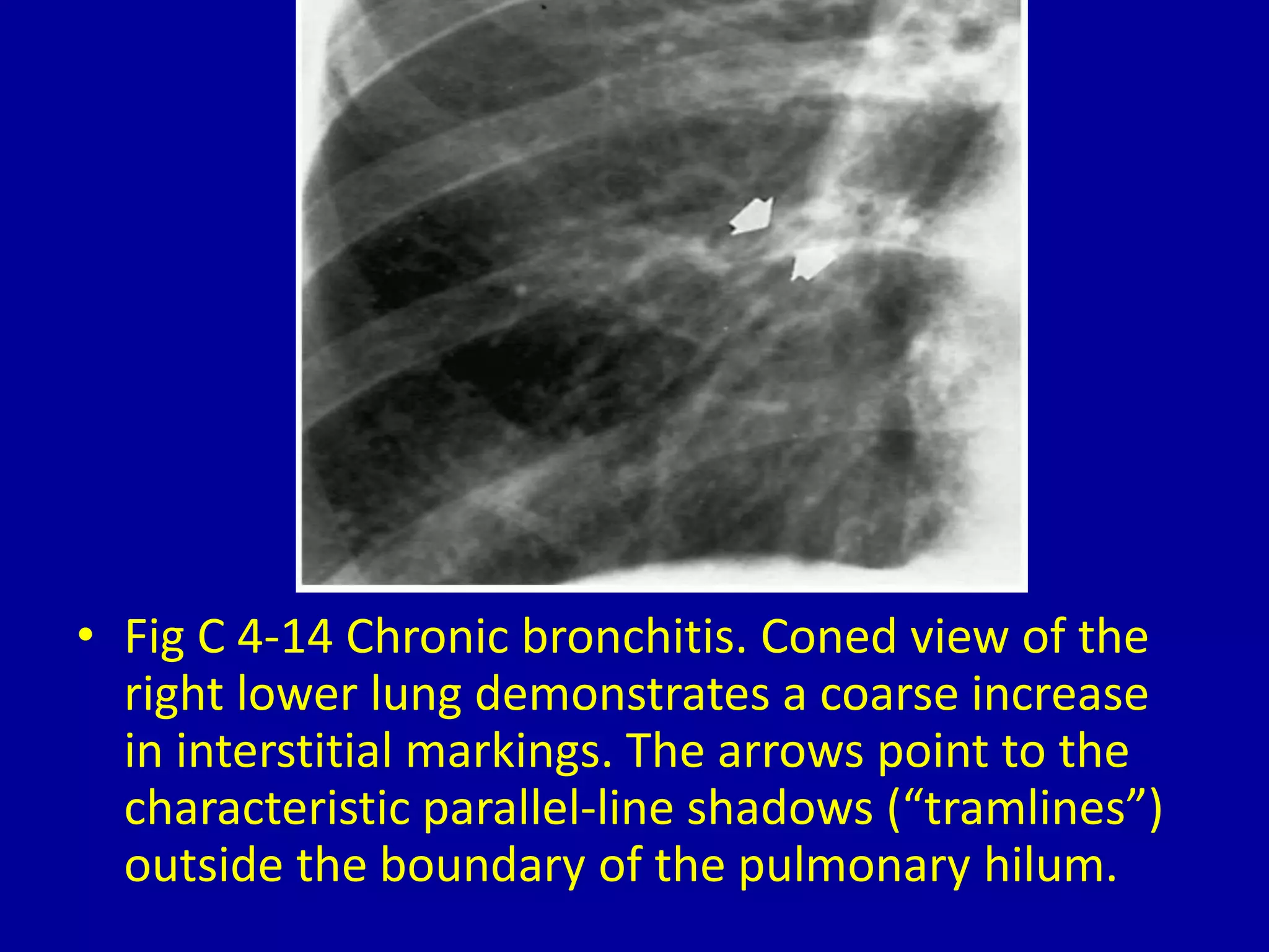 4 diffuse reticular or reticulonodular pattern | PPTX