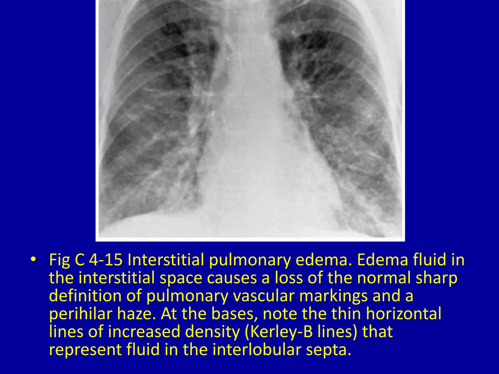 4 diffuse reticular or reticulonodular pattern | PPTX