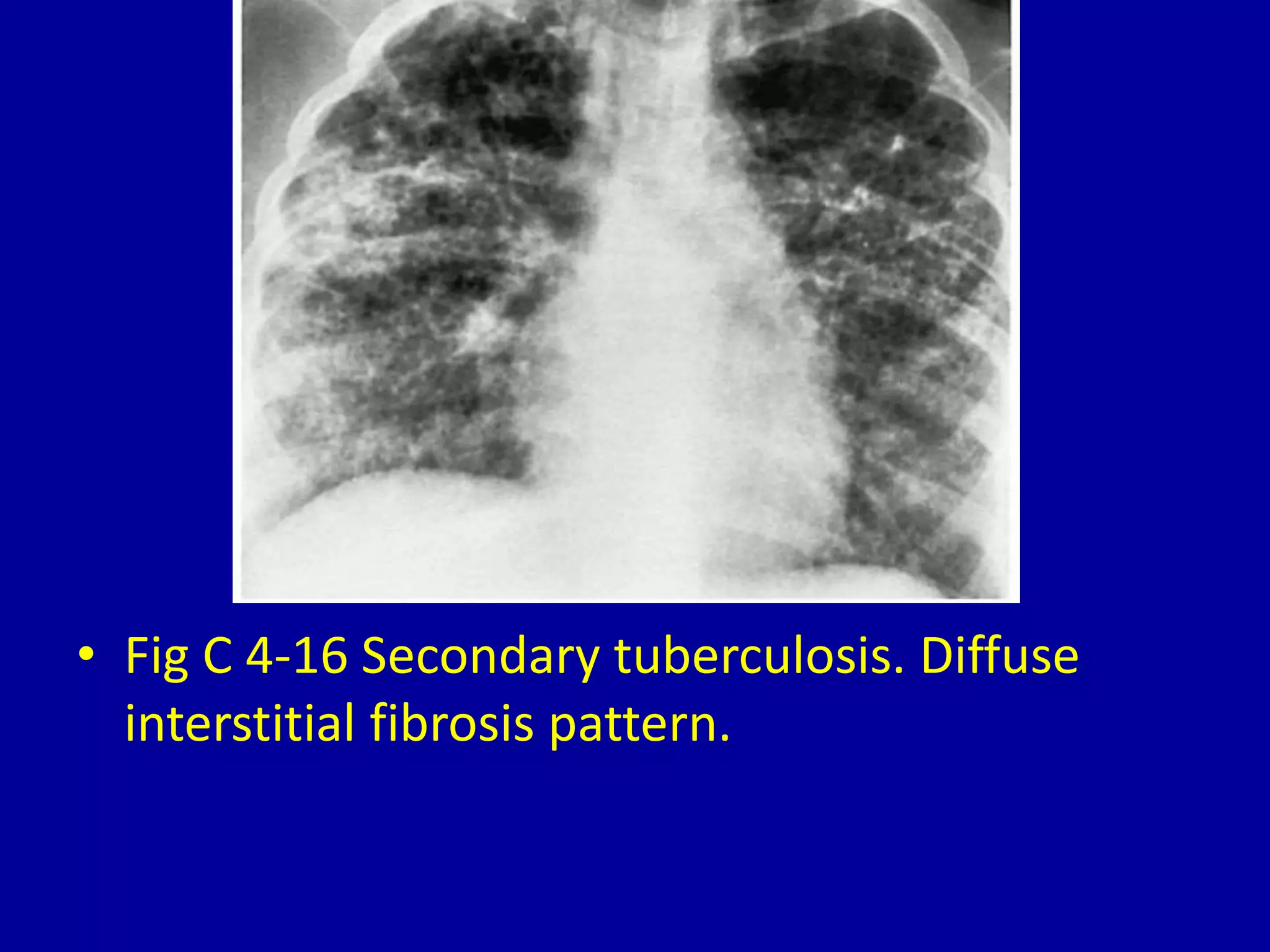 4 diffuse reticular or reticulonodular pattern | PPTX