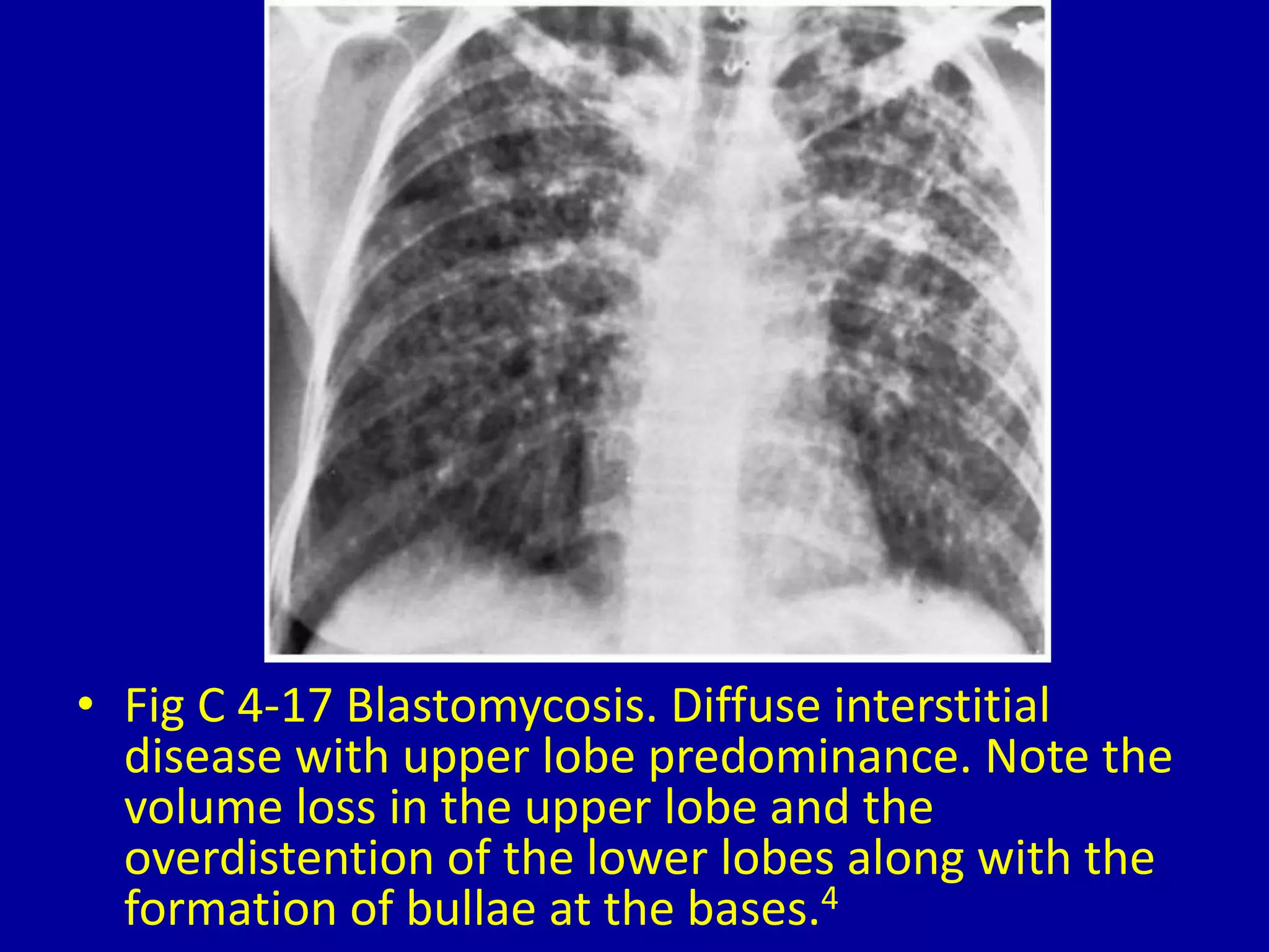 4 diffuse reticular or reticulonodular pattern | PPTX