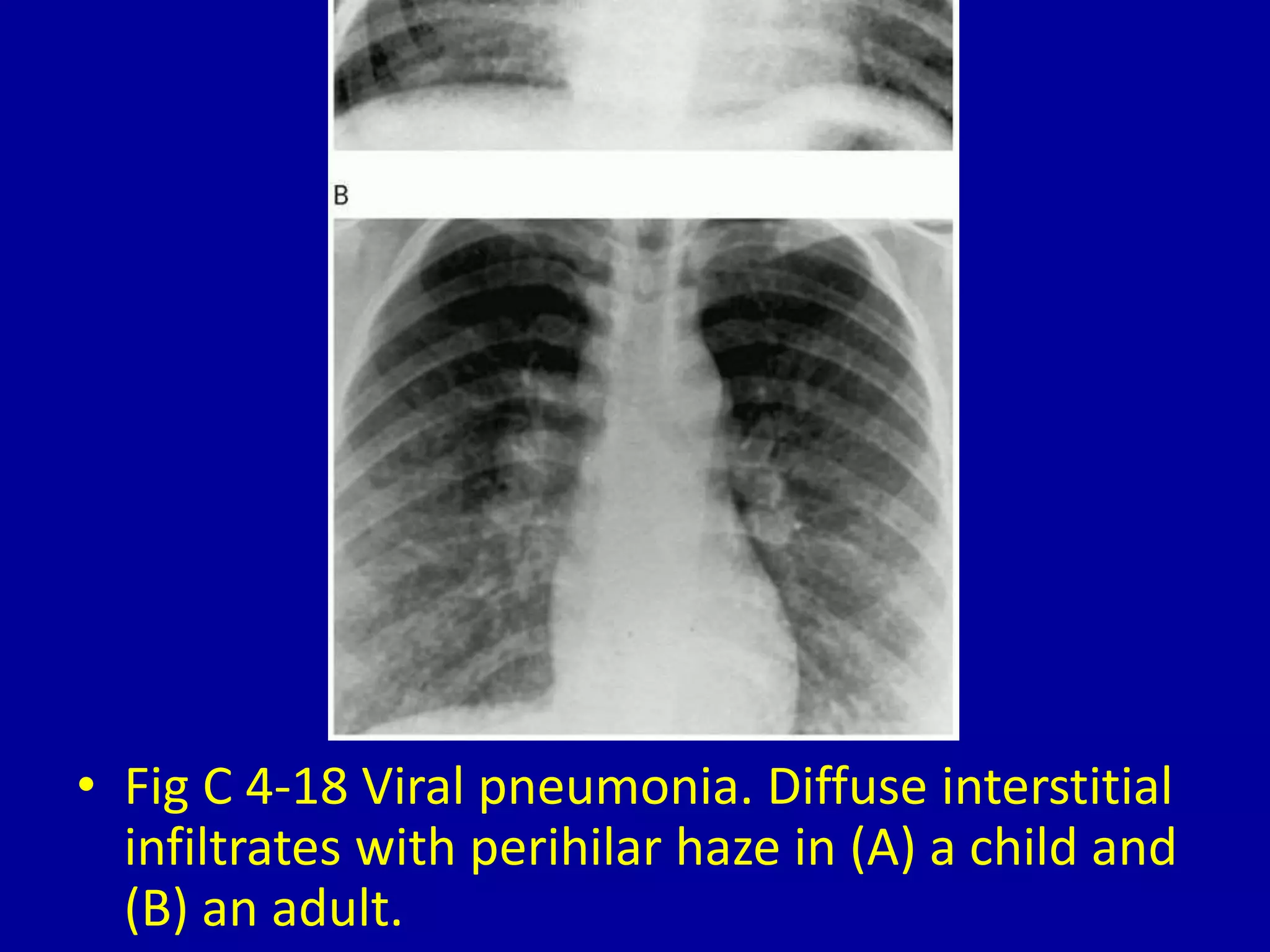 4 diffuse reticular or reticulonodular pattern | PPTX