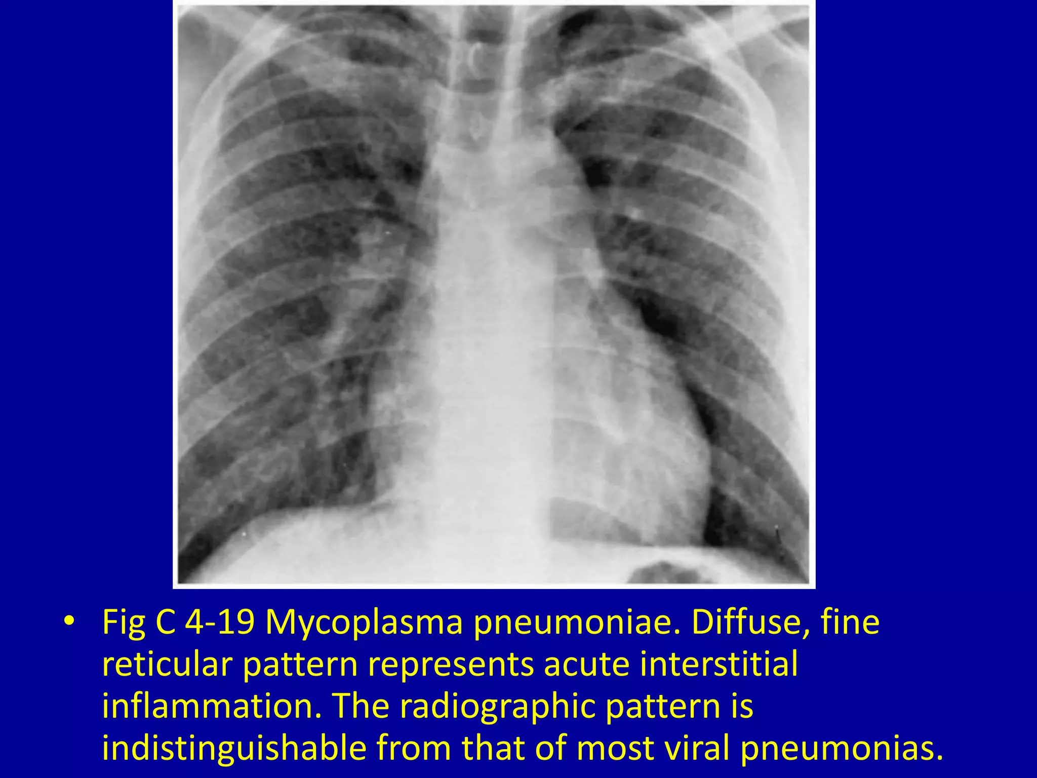 4 diffuse reticular or reticulonodular pattern | PPTX