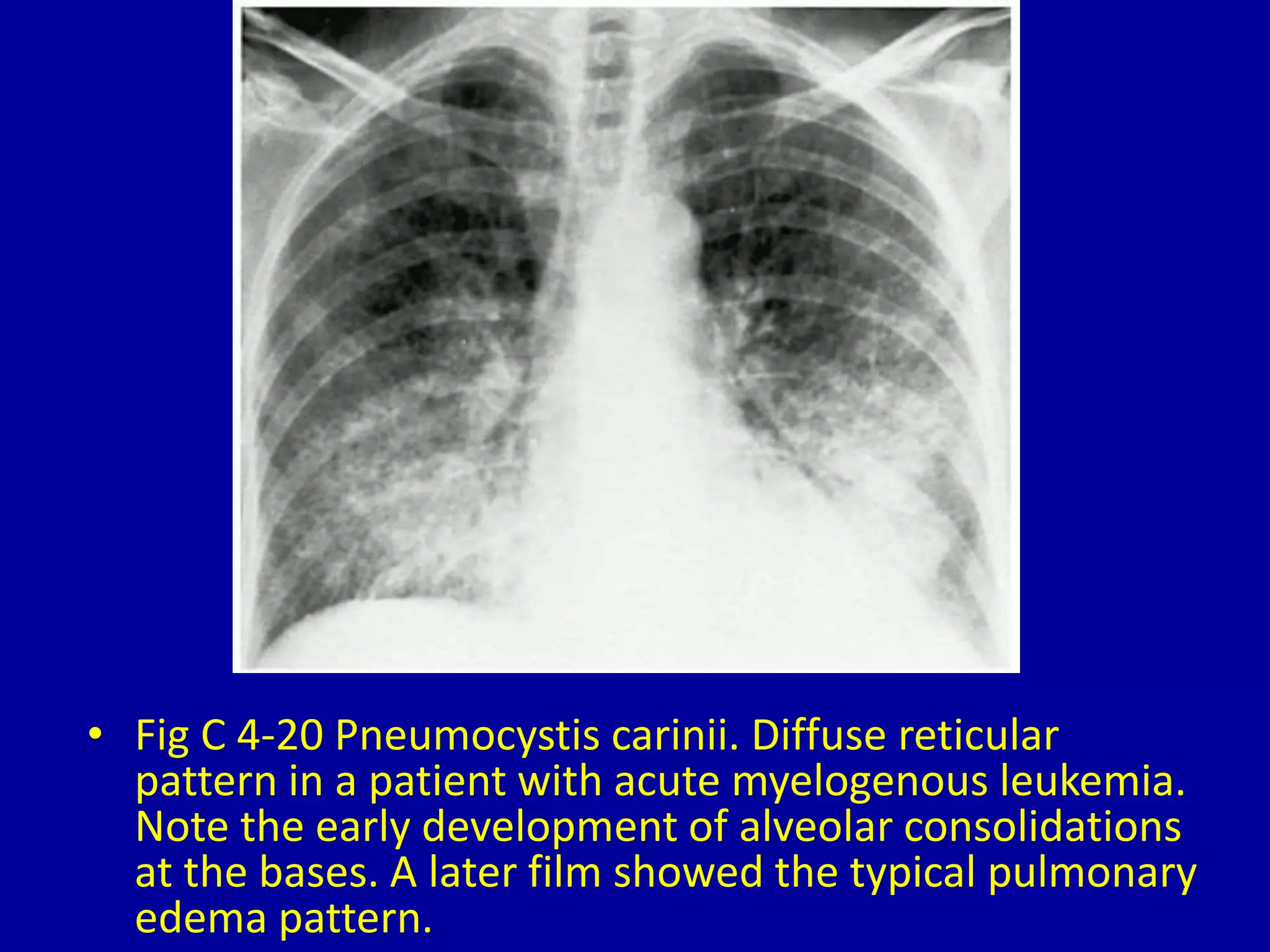 4 diffuse reticular or reticulonodular pattern | PPTX