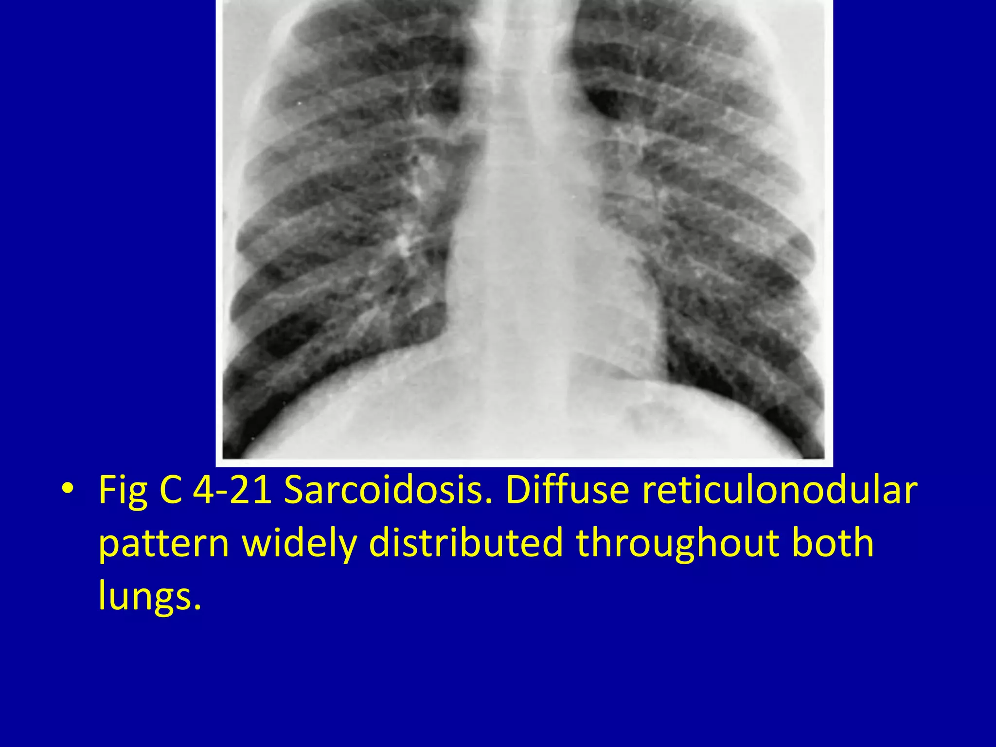 4 diffuse reticular or reticulonodular pattern | PPTX