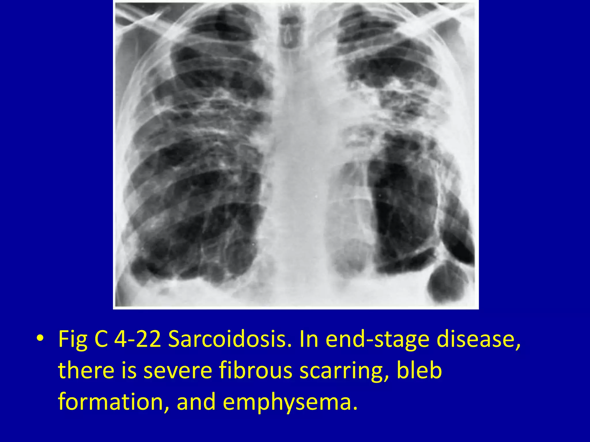 4 diffuse reticular or reticulonodular pattern | PPTX