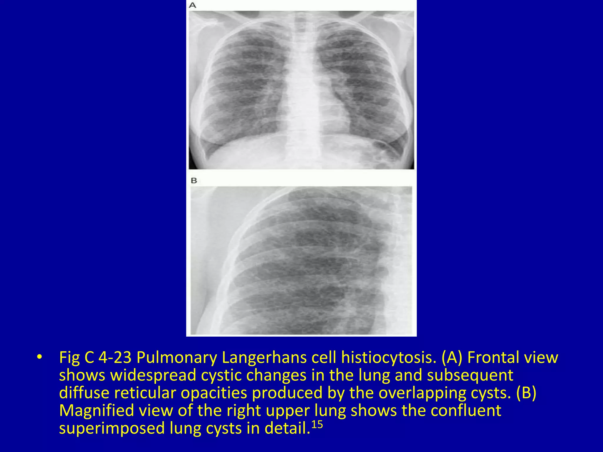 4 diffuse reticular or reticulonodular pattern | PPTX