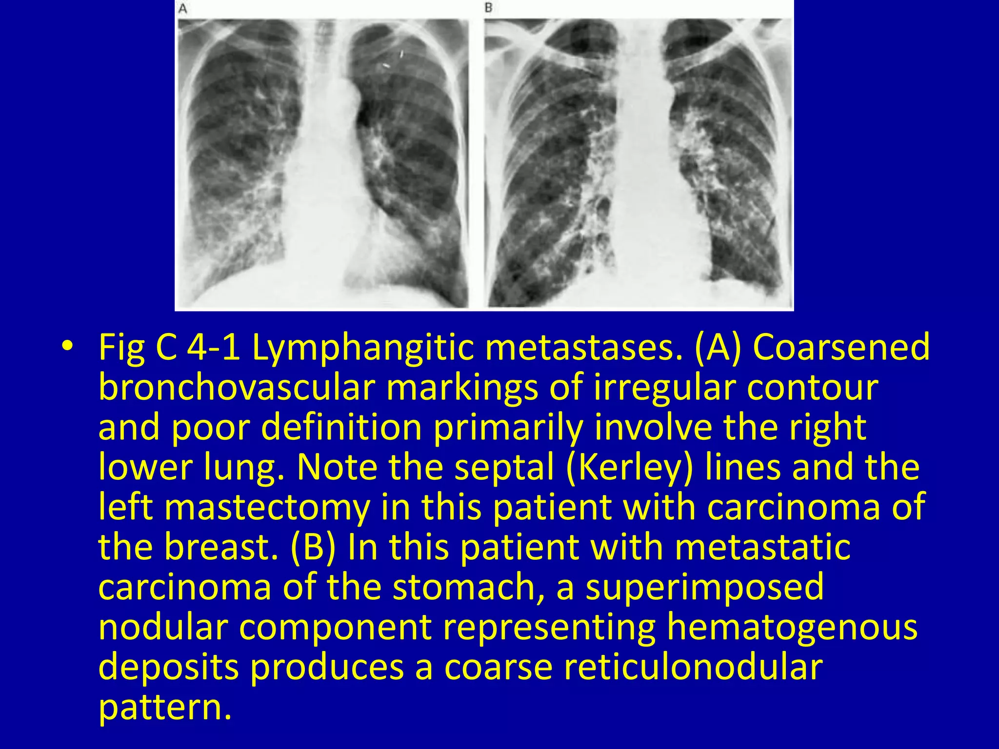 4 diffuse reticular or reticulonodular pattern | PPTX