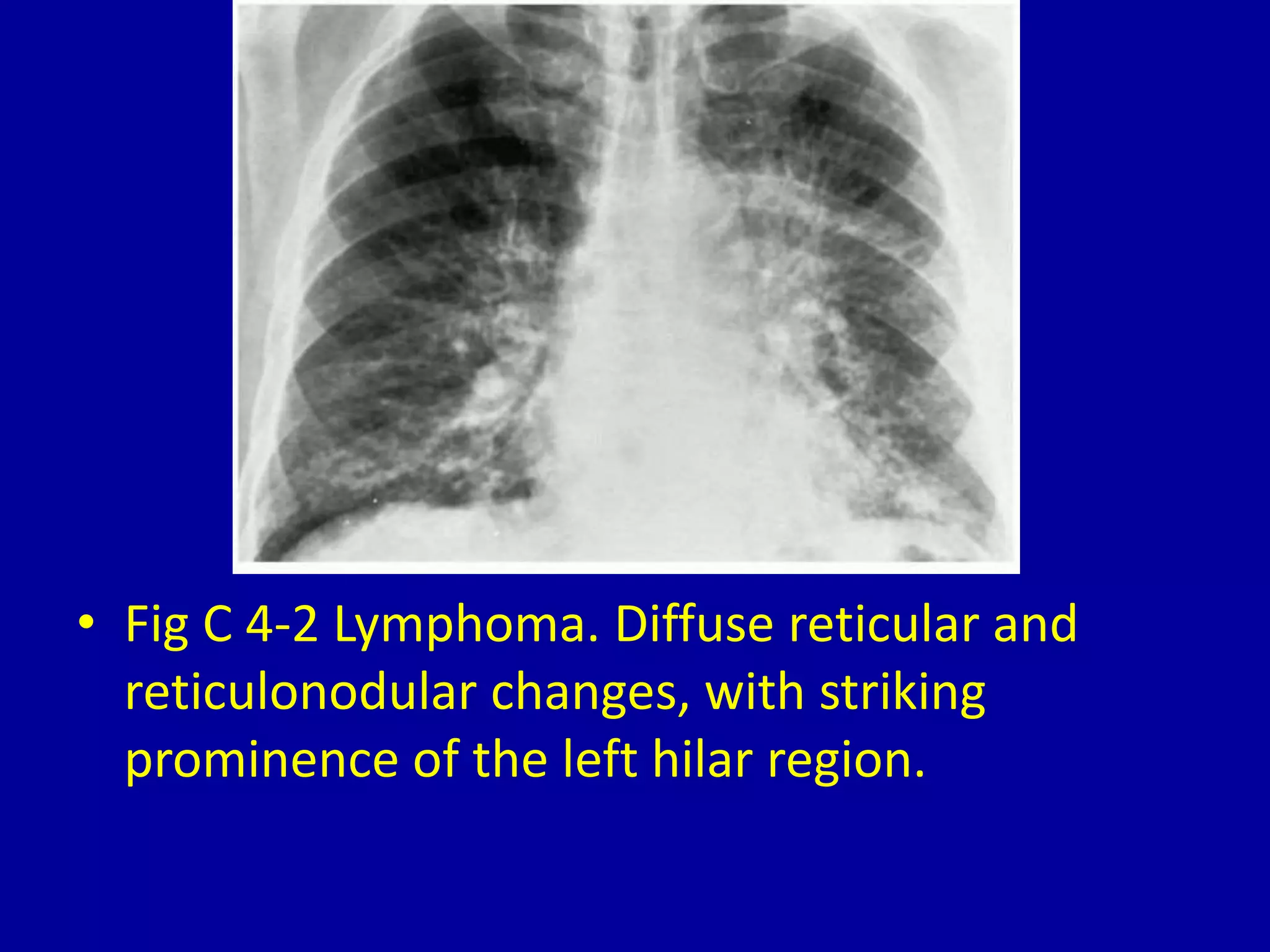 4 diffuse reticular or reticulonodular pattern | PPTX