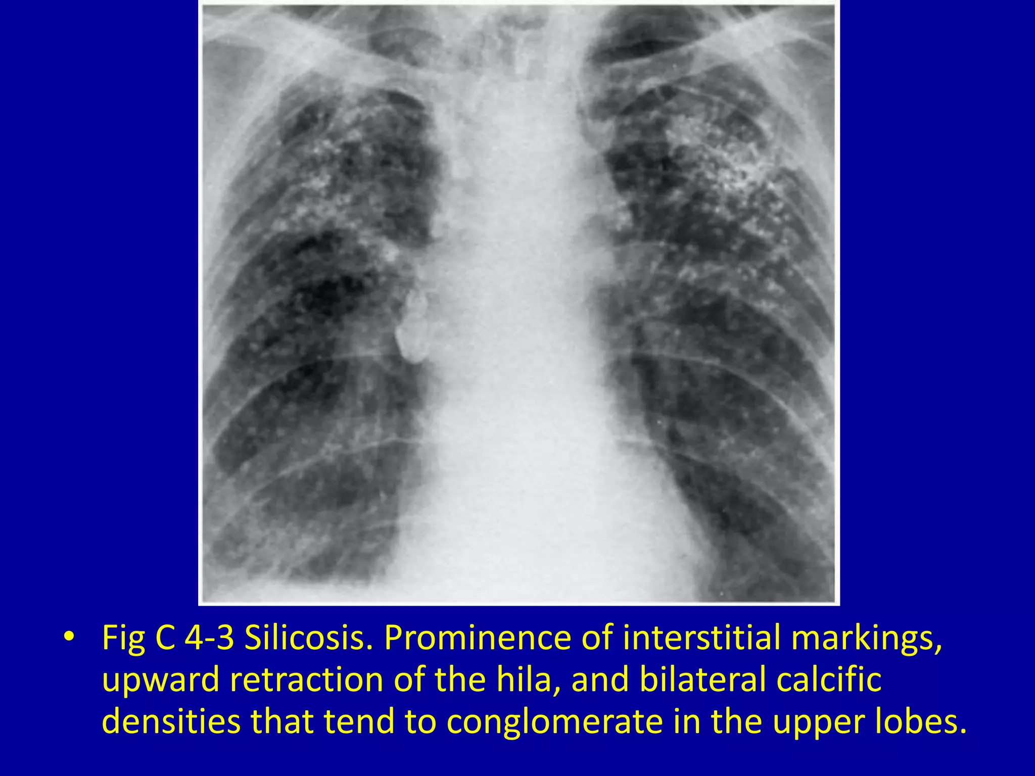4 diffuse reticular or reticulonodular pattern | PPTX