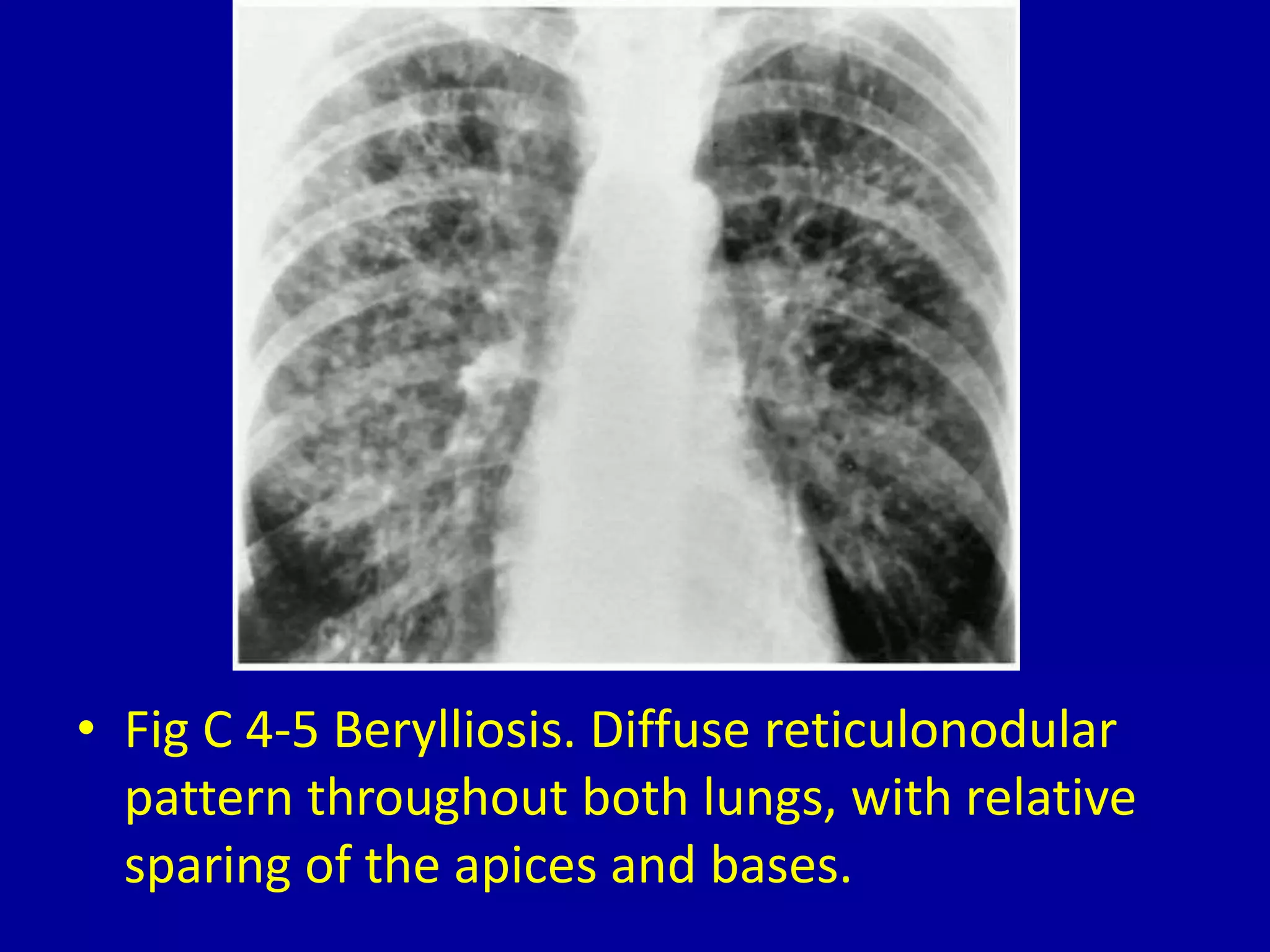 4 diffuse reticular or reticulonodular pattern | PPTX