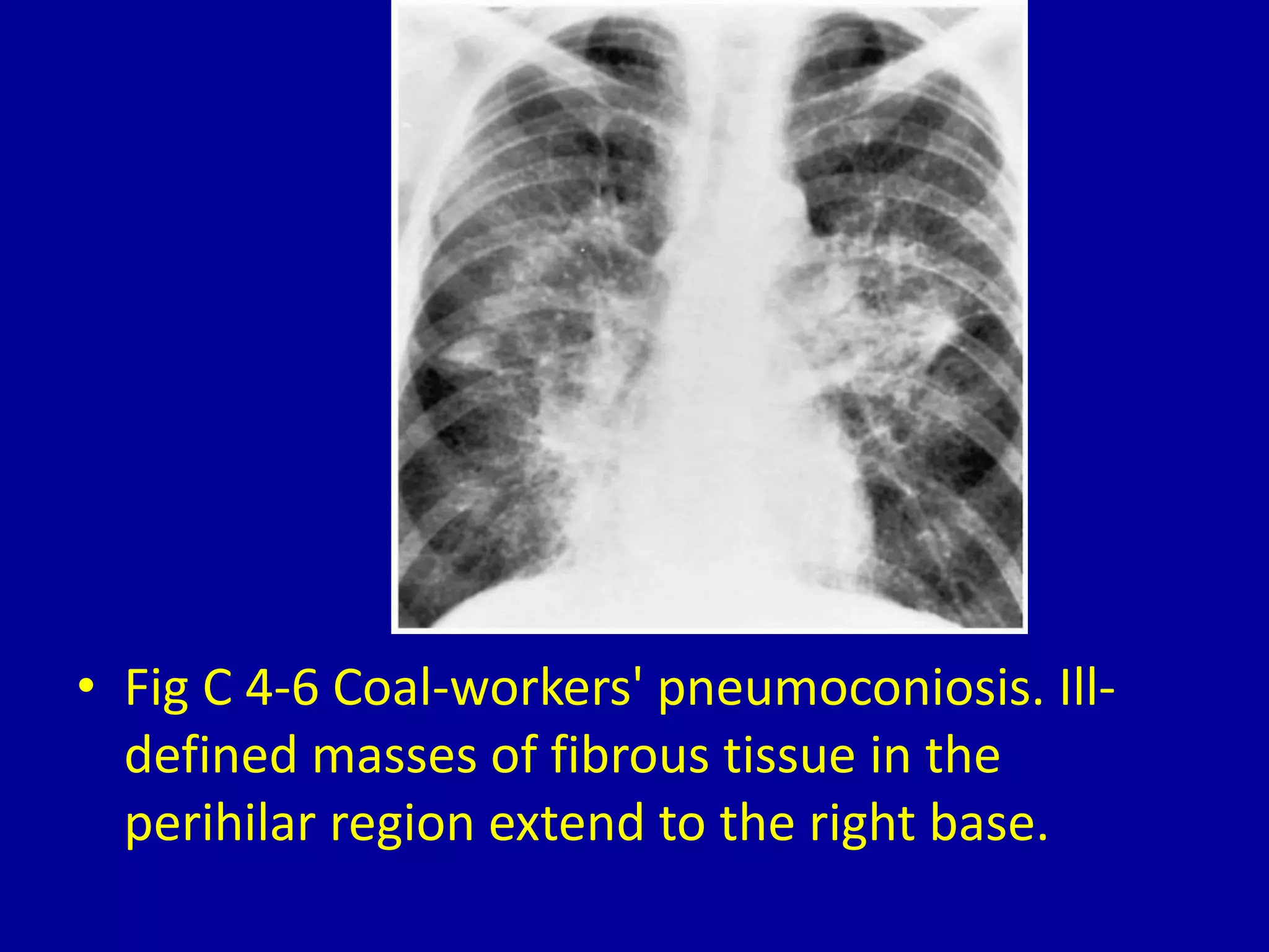 4 diffuse reticular or reticulonodular pattern | PPTX