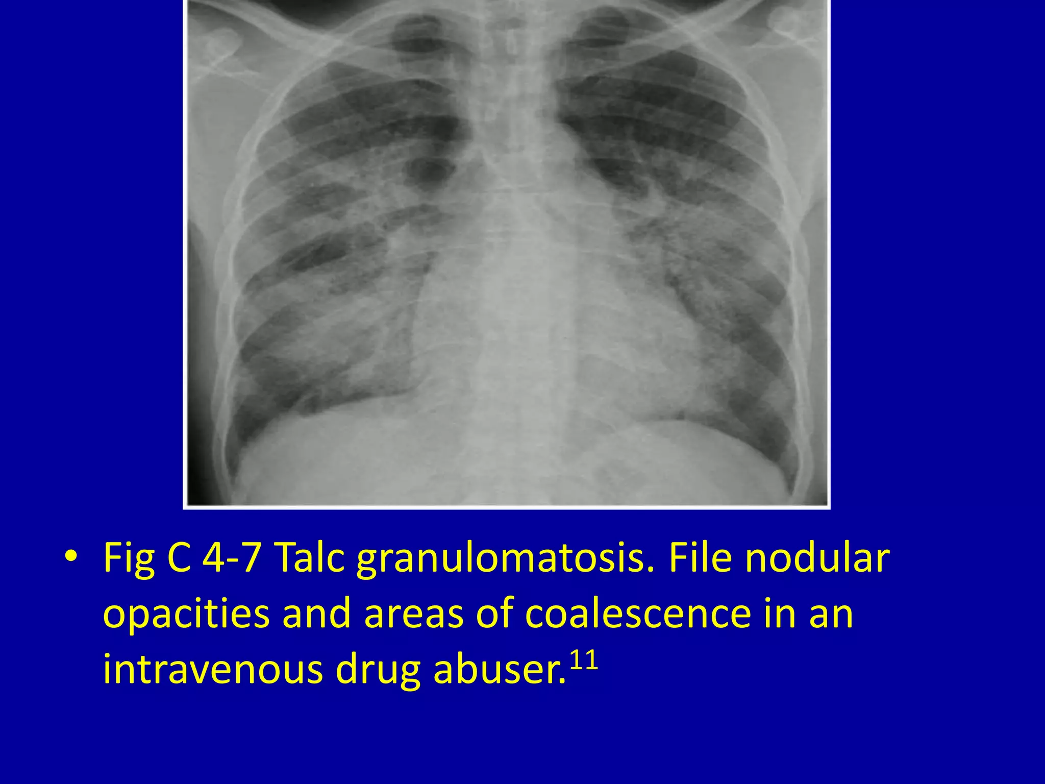 4 diffuse reticular or reticulonodular pattern | PPTX