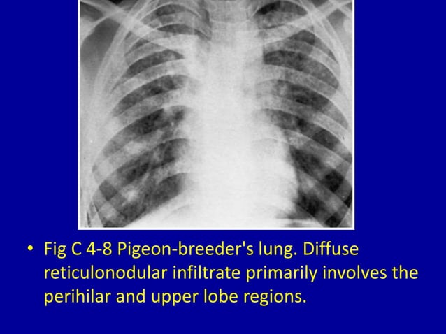 4 diffuse reticular or reticulonodular pattern | PPTX