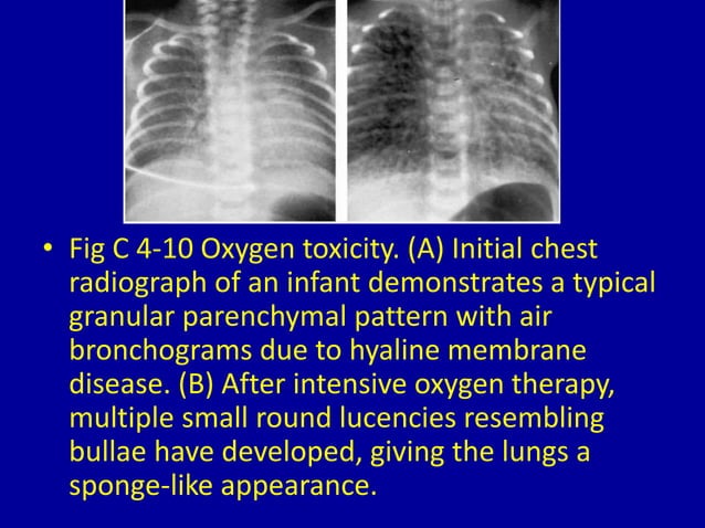 4 diffuse reticular or reticulonodular pattern | PPTX