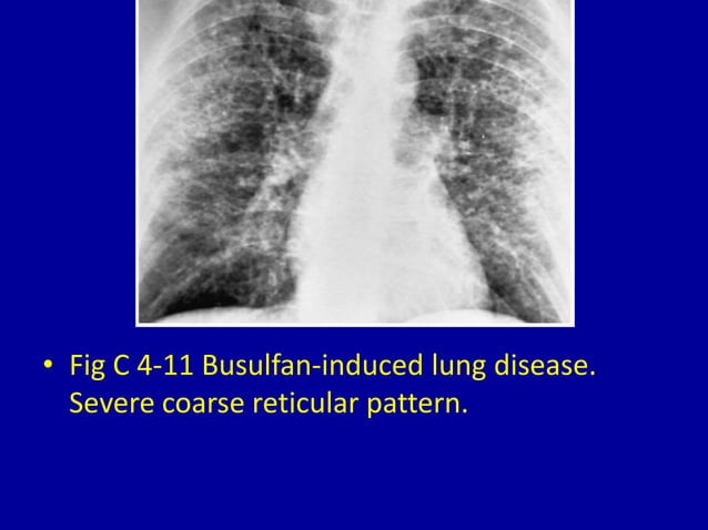 4 diffuse reticular or reticulonodular pattern | PPTX