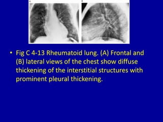 4 diffuse reticular or reticulonodular pattern | PPTX