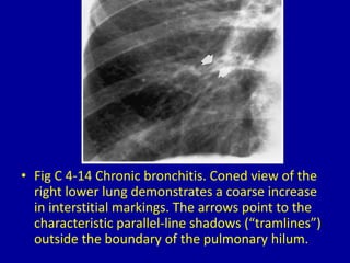 4 diffuse reticular or reticulonodular pattern | PPT