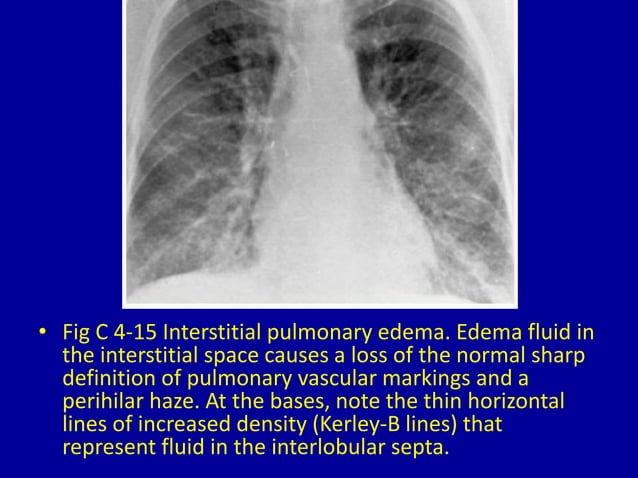 4 diffuse reticular or reticulonodular pattern | PPTX