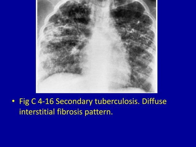 4 diffuse reticular or reticulonodular pattern | PPTX