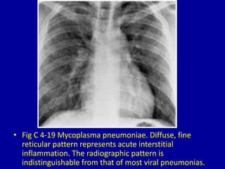 Interstitial Pneumonias An Acute Reticular Pattern Is Most