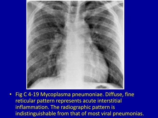 4 diffuse reticular or reticulonodular pattern | PPTX