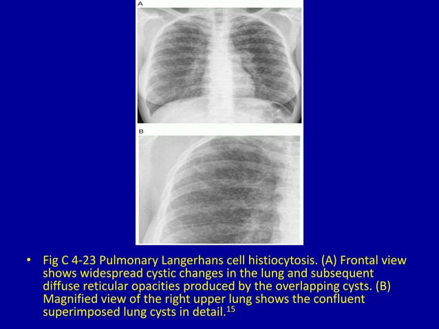 4 diffuse reticular or reticulonodular pattern | PPTX