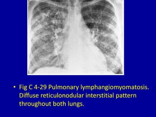 4 diffuse reticular or reticulonodular pattern | PPT