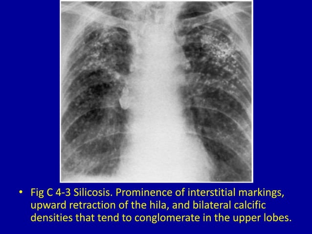 4 diffuse reticular or reticulonodular pattern | PPTX