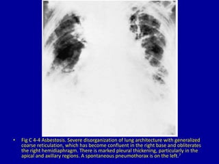 4 diffuse reticular or reticulonodular pattern | PPTX