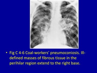 4 diffuse reticular or reticulonodular pattern | PPTX
