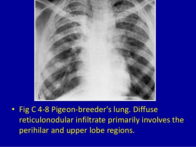 4 diffuse reticular or reticulonodular pattern