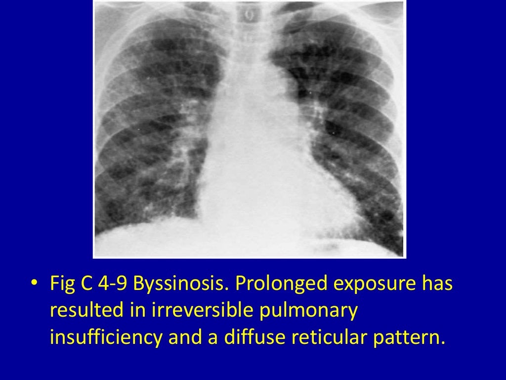 4 diffuse reticular or reticulonodular pattern