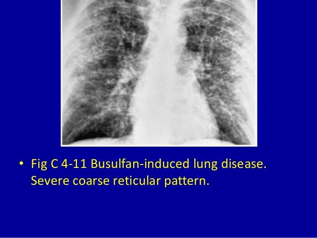 4 diffuse reticular or reticulonodular pattern