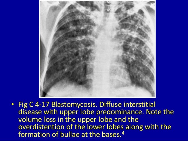 4 diffuse reticular or reticulonodular pattern
