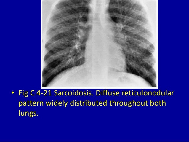 4 diffuse reticular or reticulonodular pattern