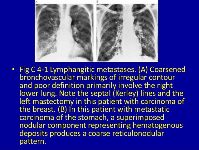 4 diffuse reticular or reticulonodular pattern
