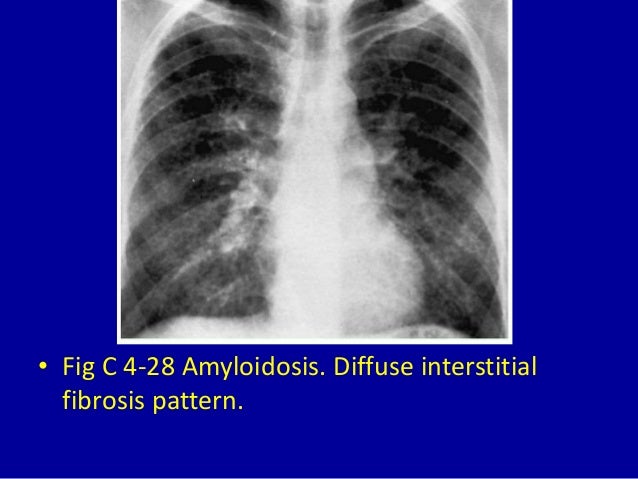 4 diffuse reticular or reticulonodular pattern