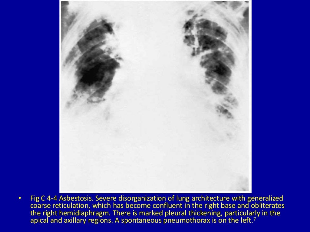 4 diffuse reticular or reticulonodular pattern