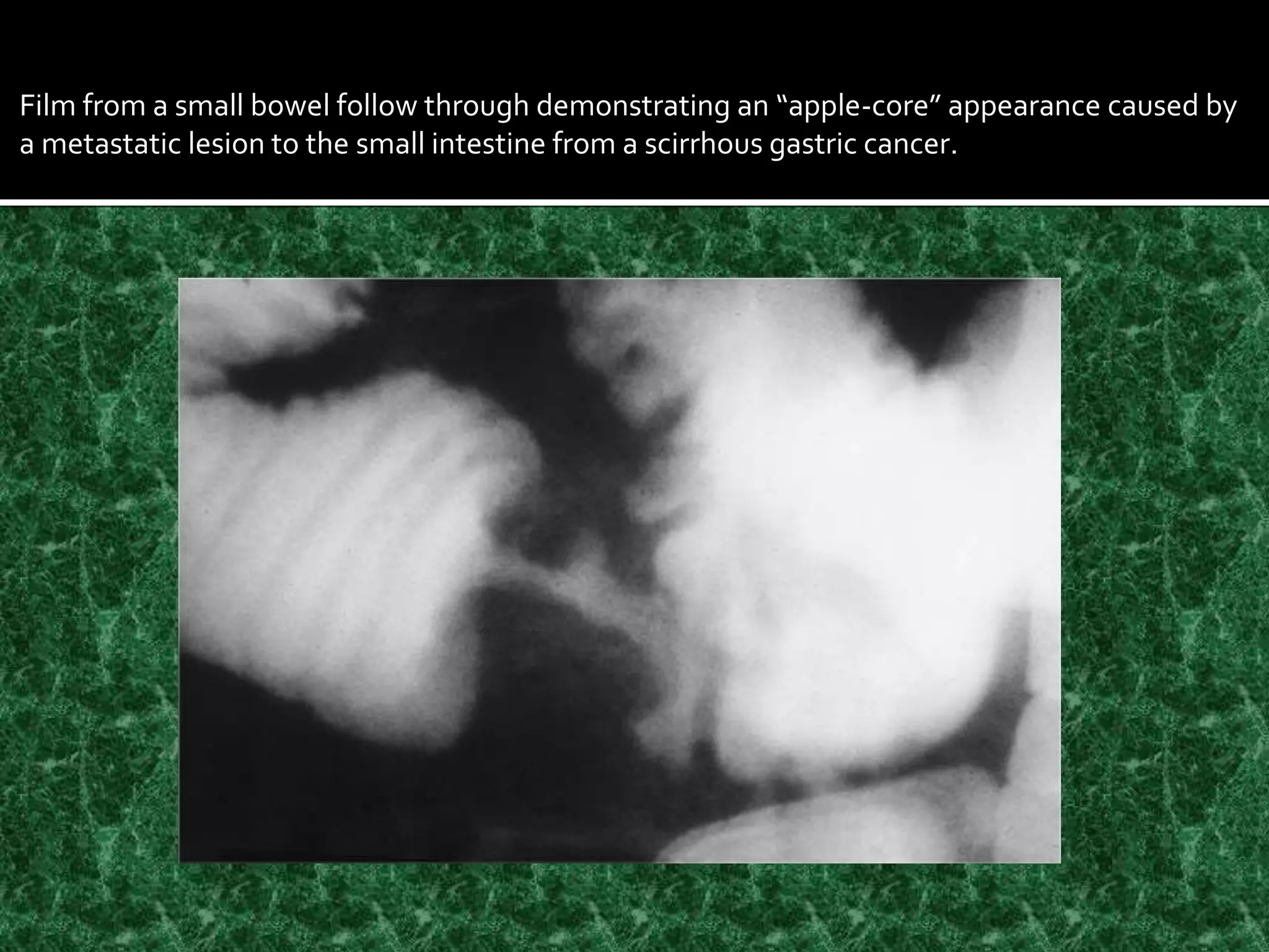 small_bowel_tumrs.pptx