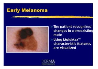 Molemax Presentation | PPT