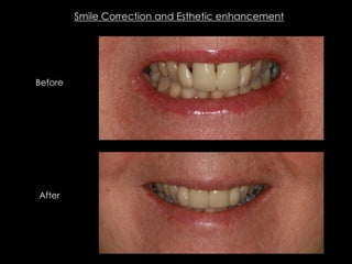Smile Correction and Esthetic Enhancement | PPT