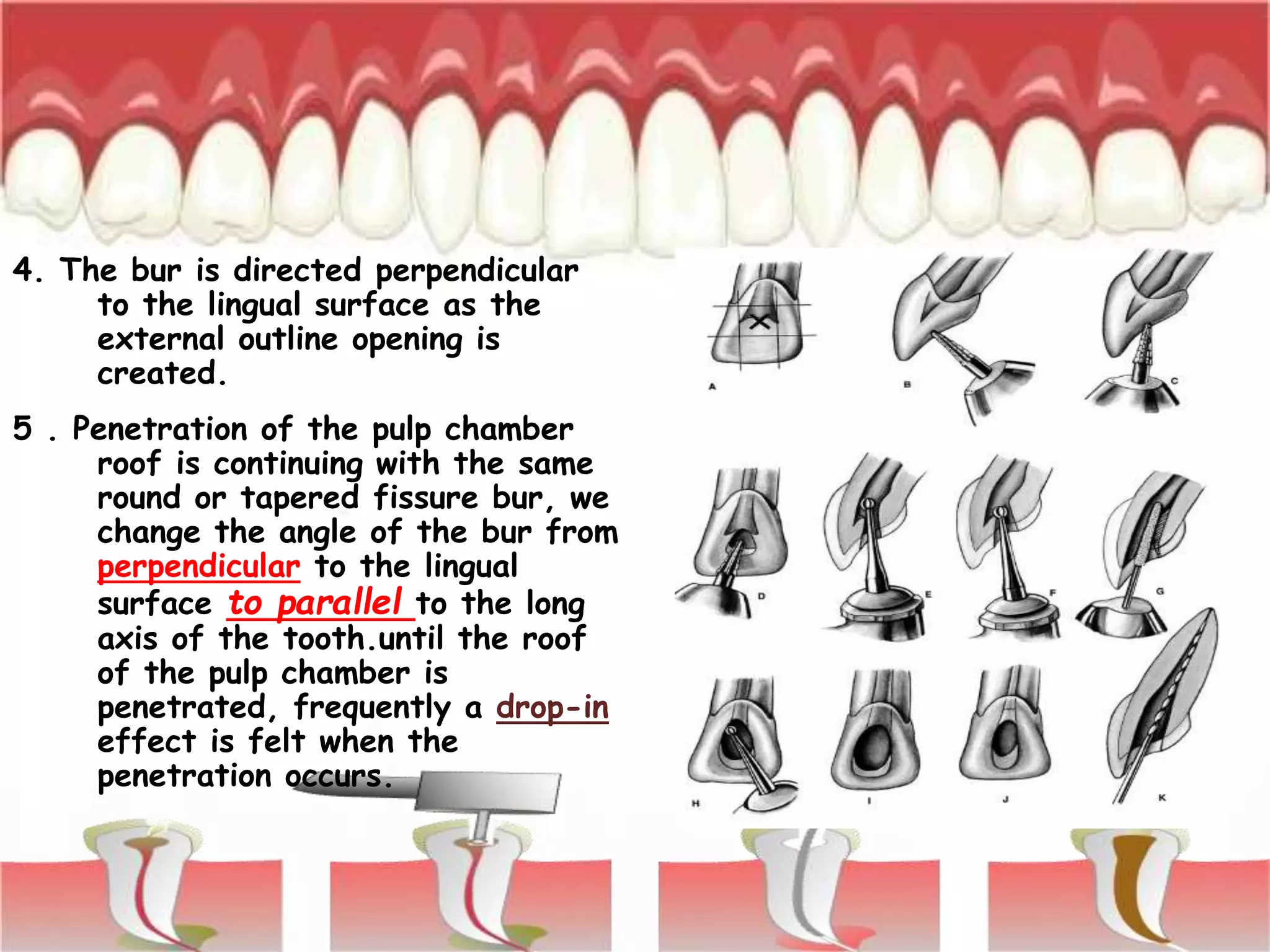 Access Cavity Preparation in : Maxillary Lateral Incisor | PPTX